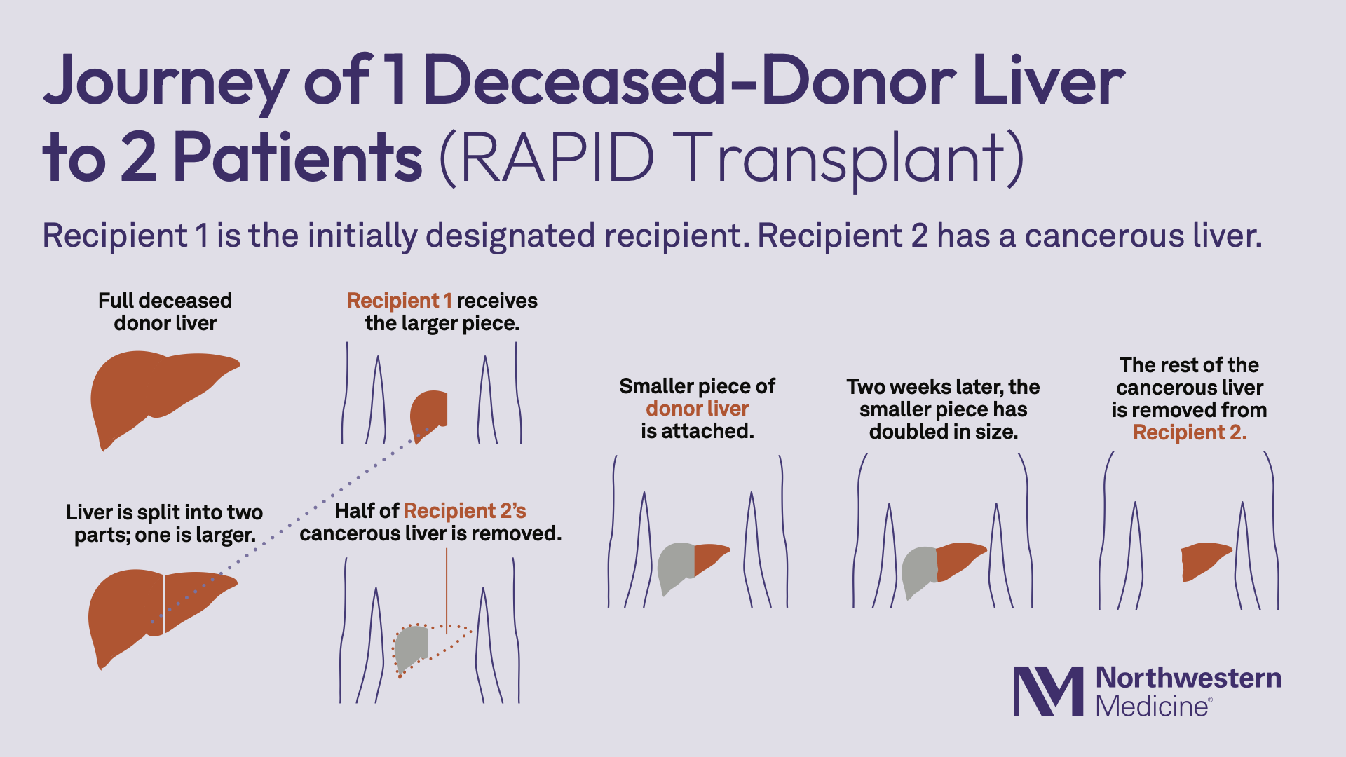 Northwestern Medicine launches clinical program to make liver ...
