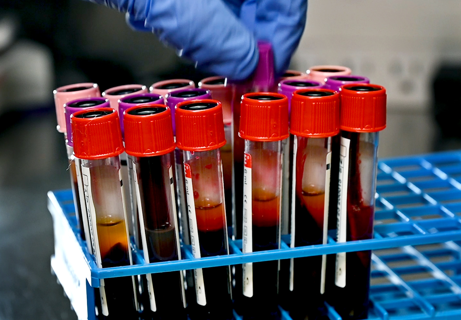 UCHealth Parkview adds to biobank data