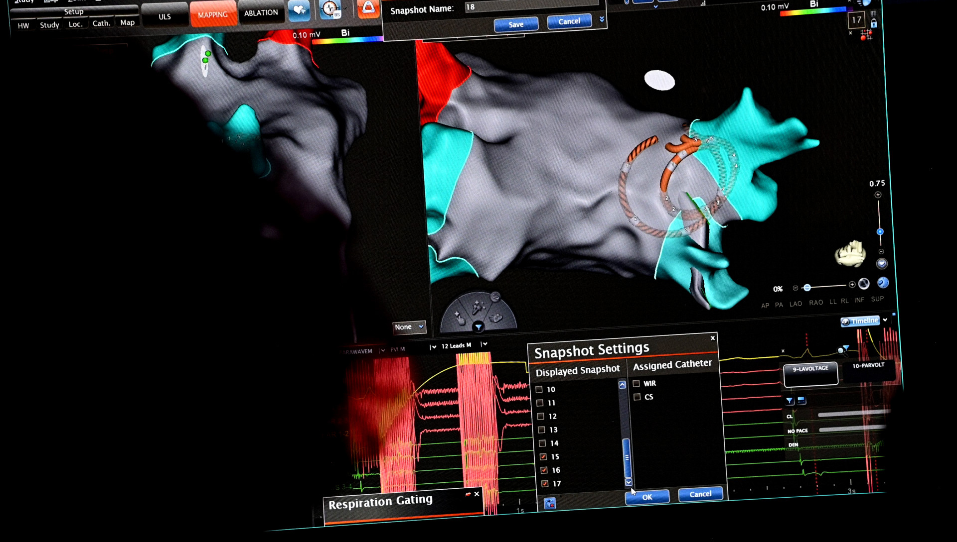 KKTV-TV (Colorado Springs) | New safer, less invasive afib treatement ...